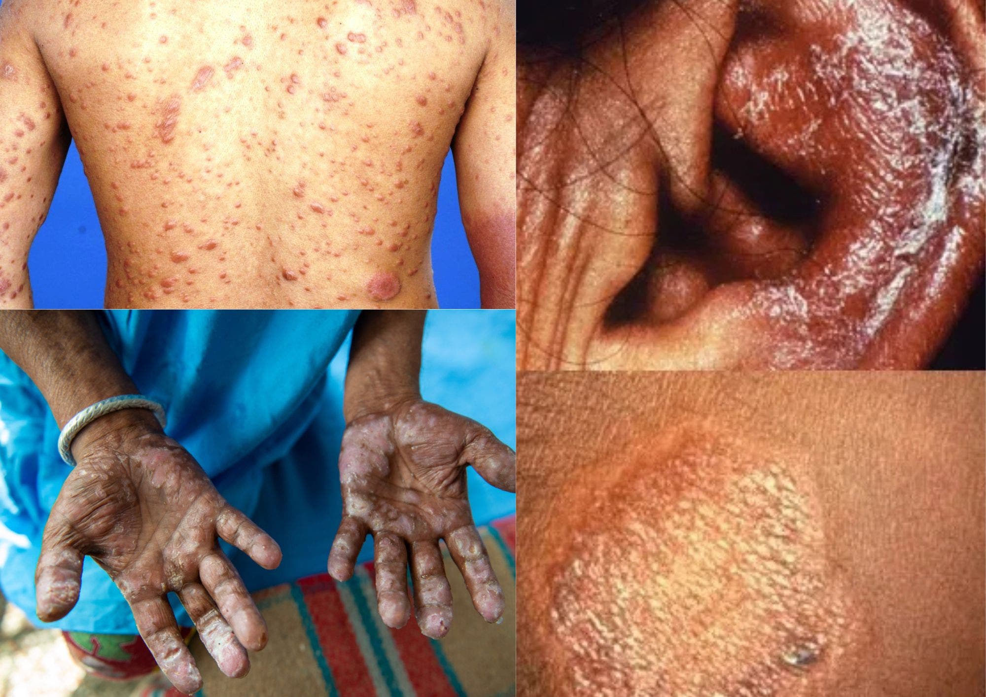 ¿Sabías que hoy es el Día Mundial de la Lepra? Aprenda más sobre esta ...